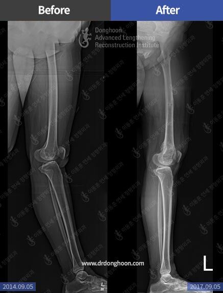 Genu Recurvatum Limb Lengthening And Complex Reconstruction Service Korea Dalri