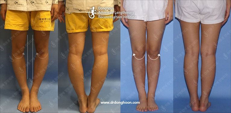 leg shortening surgery korea